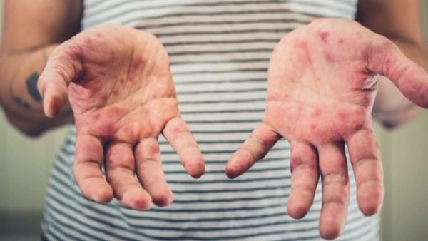 Measles Infection