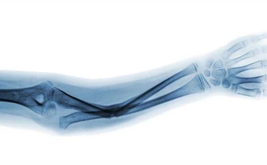 Broken Bones:Workplace First Aid Basics