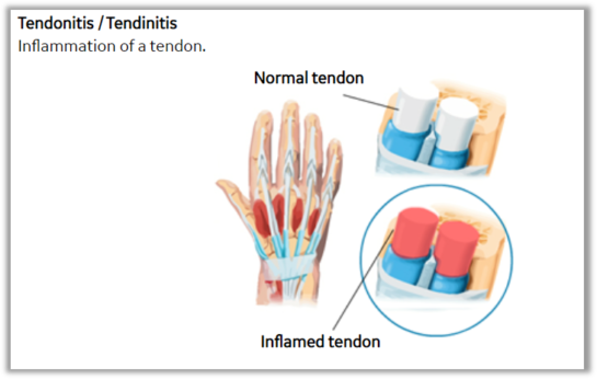 Preventing Musculoskeletal Disorders HSSE WORLD
